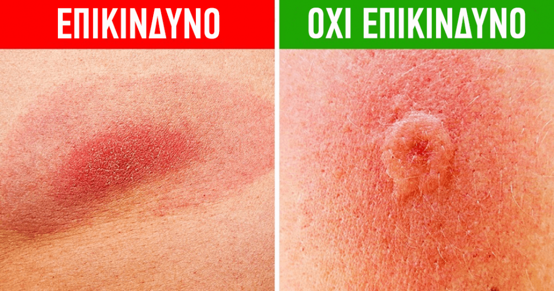 Προσοχή! Πως να αναγνωρίσετε τα τσιμπήματα από έντομα | VIRAL ...