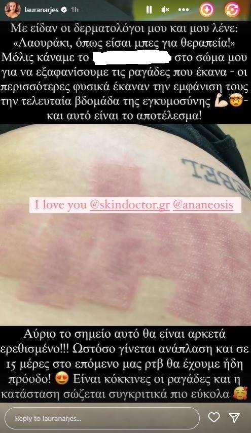 Λάουρα Νάργες: Τα σημάδια που απέκτησε στο σώμα της κατά την περίοδο ...